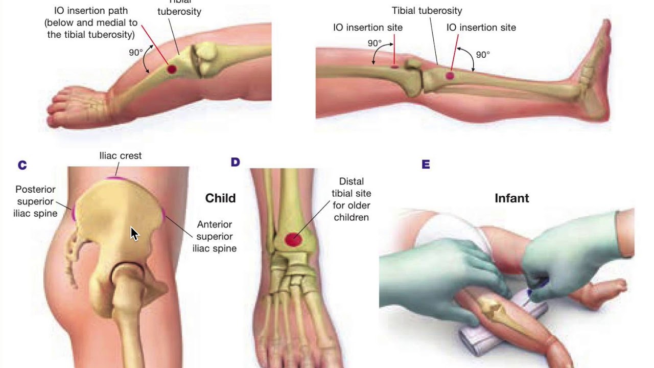 How To Establish IO Intraosseous Access In Shock YouTube