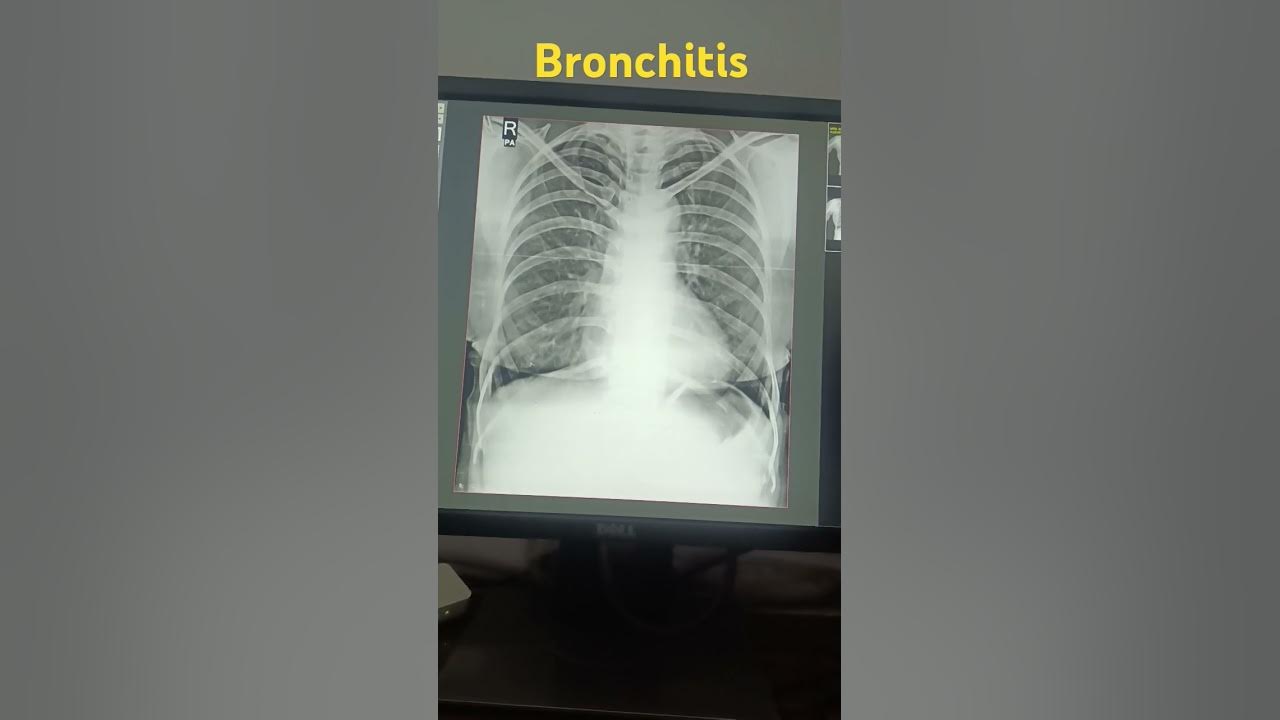 xray Chest pa Bronchitis BVM- are prominent Lung fild - YouTube