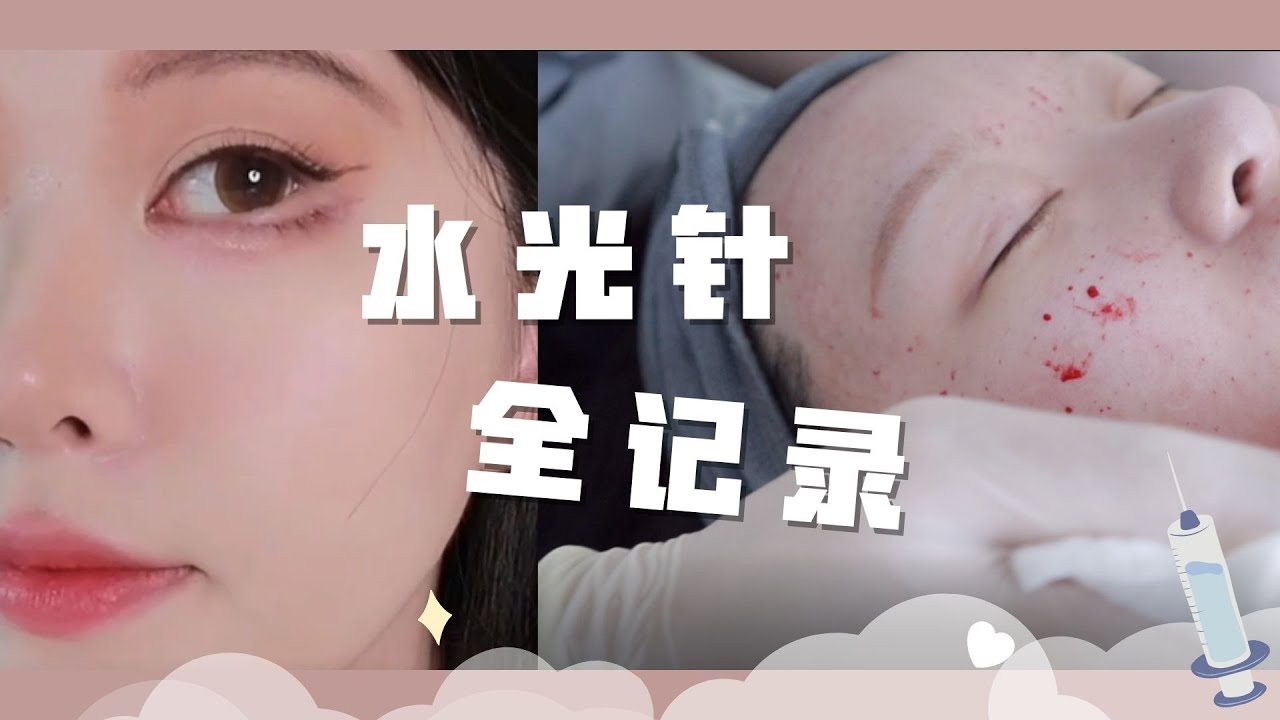 [ENG SUB] 医美 |水光针体验全记录之干皮福音|泰奥水光针| Mesotherapy |TEOSYAL Redensity |Why ...