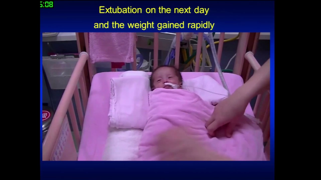 Percutaneous closure of PDA in premature - YouTube