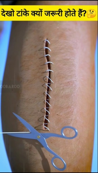How Do Body Stitches Heal Wounds?(3D Animation) #facts #shorts ...
