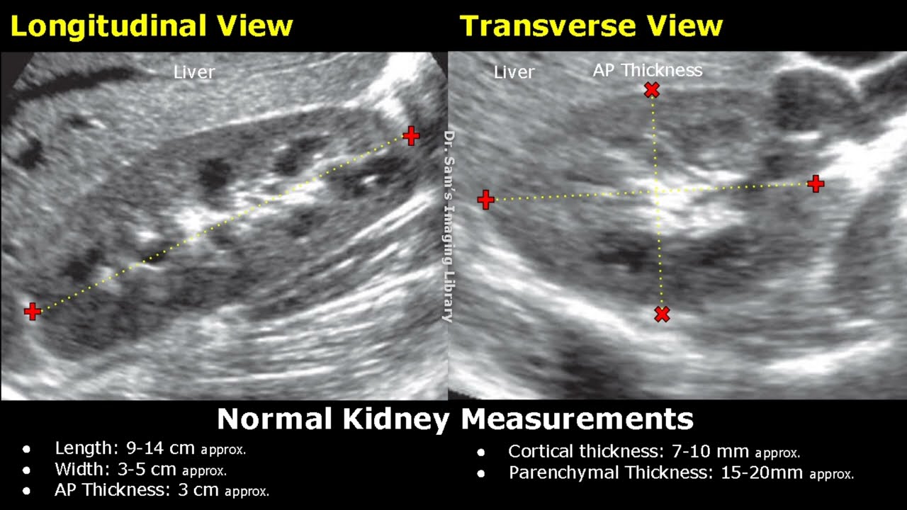 How To Measure Kidney On Ultrasound Renal Length Width AP Thickness How To Measure Kidney On Ultrasound Renal Length Width AP Thickness