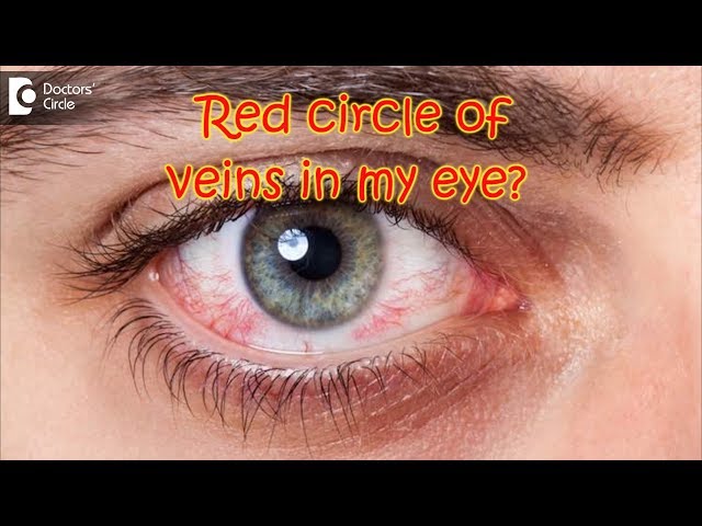What Causes Blood Vessels In Eye To Turn Red - Infoupdate.org