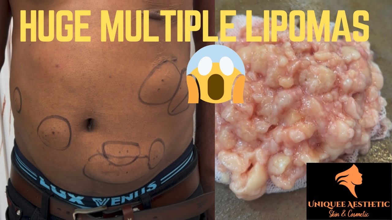 Lipoma Treatment || Multiple Huge Lipomas Treatment || Lipoma Natural ...