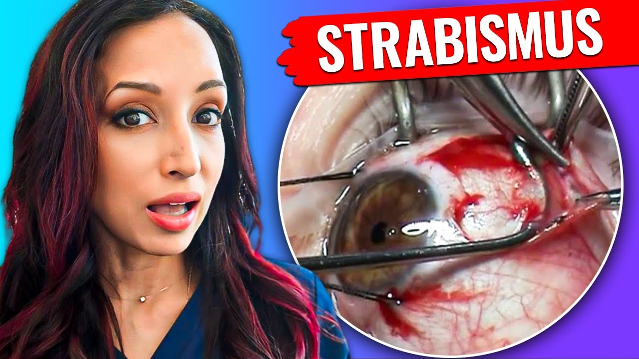 What Is Adjustable Suture Strabismus Surgery? Eye Doctor Explains - YouTube