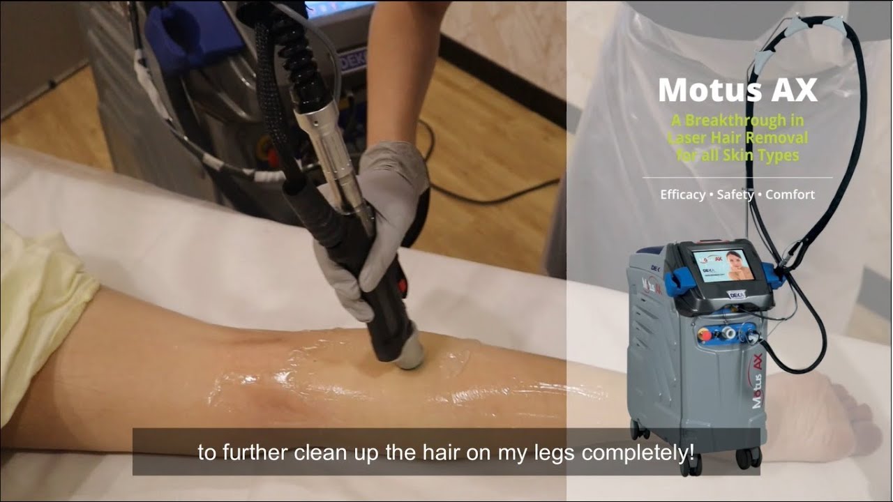 Deka Motus AX Hair Removal at Veo Clinic - YouTube