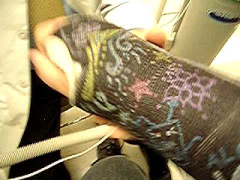 Doc Sawing Off My Arm...I mean cast...fractured elbow cast removal with ...