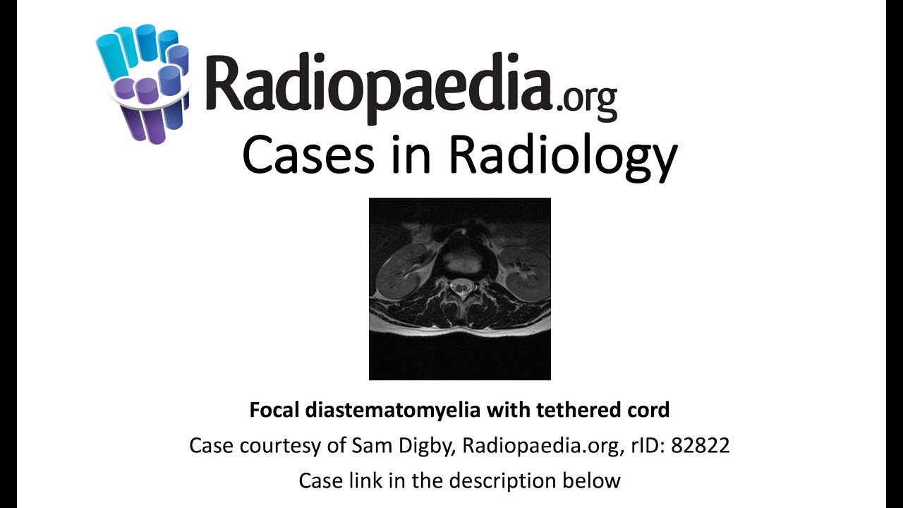 Focal diastematomyelia with tethered cord (Radiopaedia.org) Cases in ...