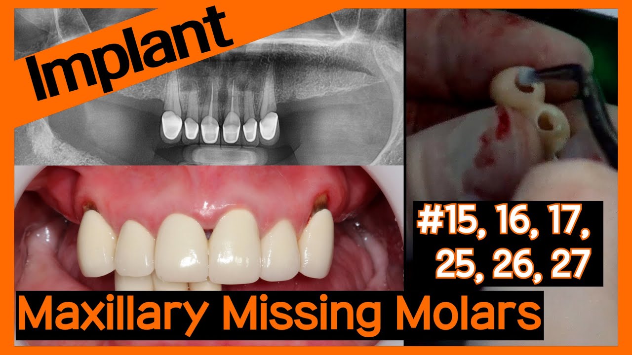 [Online Surgery] OneGuide surgery for maxillary missing molars - YouTube