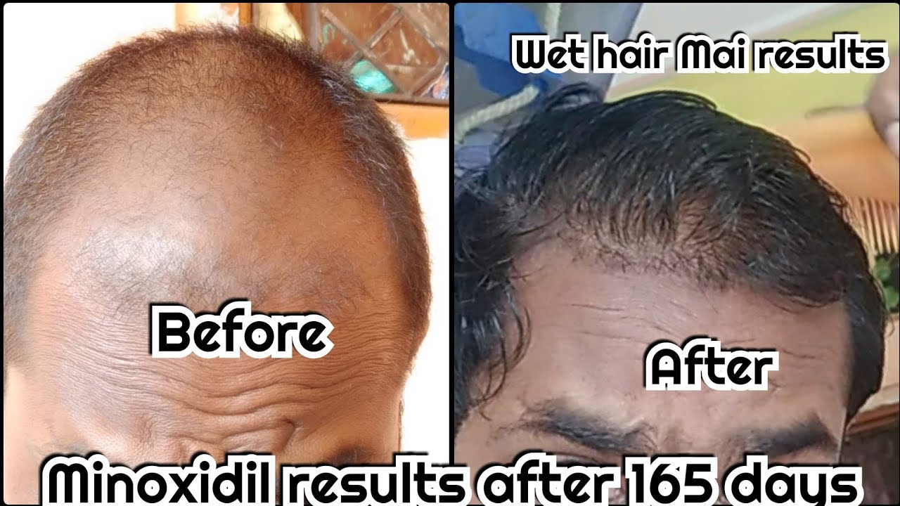 Minoxidil results in wet hair. After 145 days of use. #Morrf 10% # ...