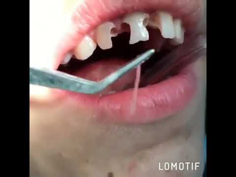 Tooth nerve removal - YouTube