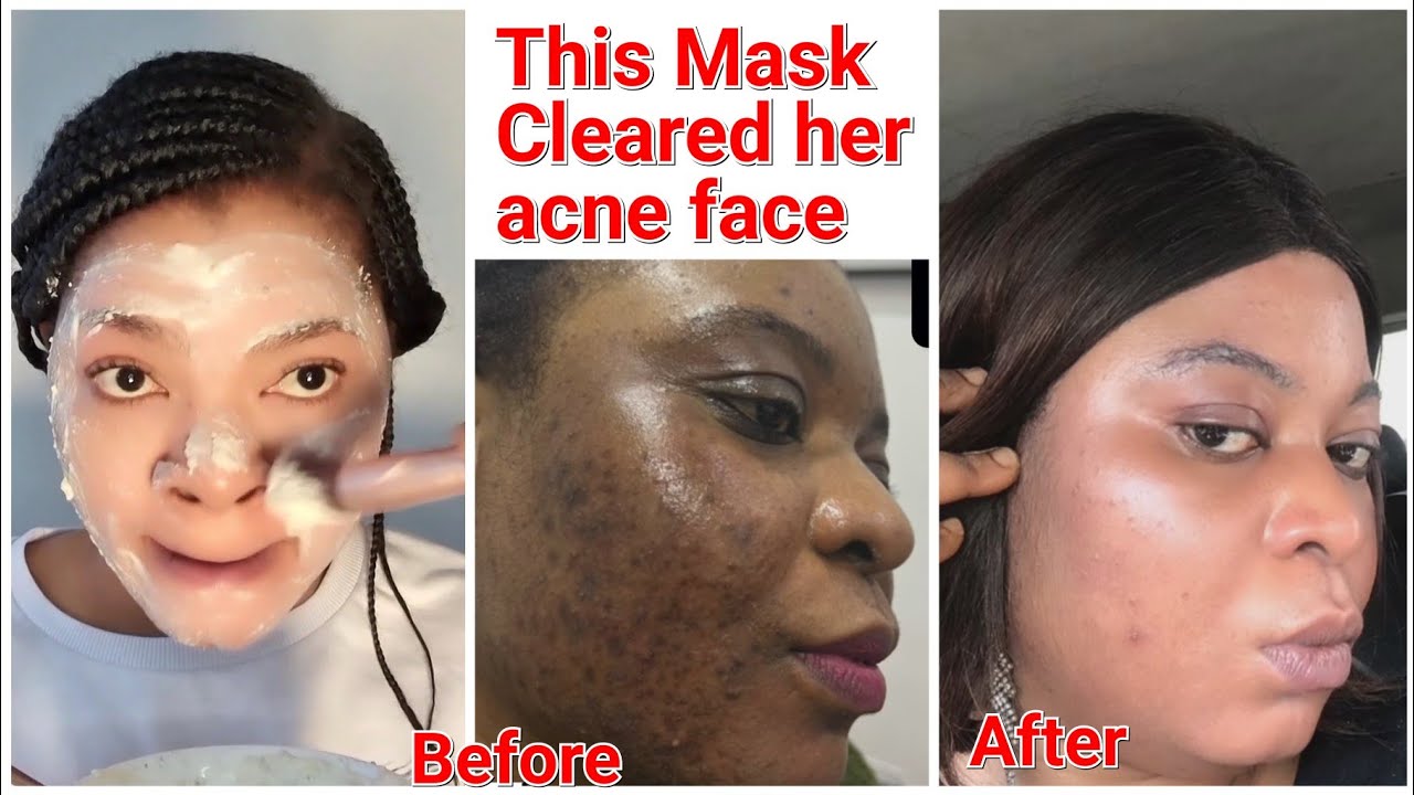 She cleared her Stubborn pimples, Dark spots & acne using this mask ...