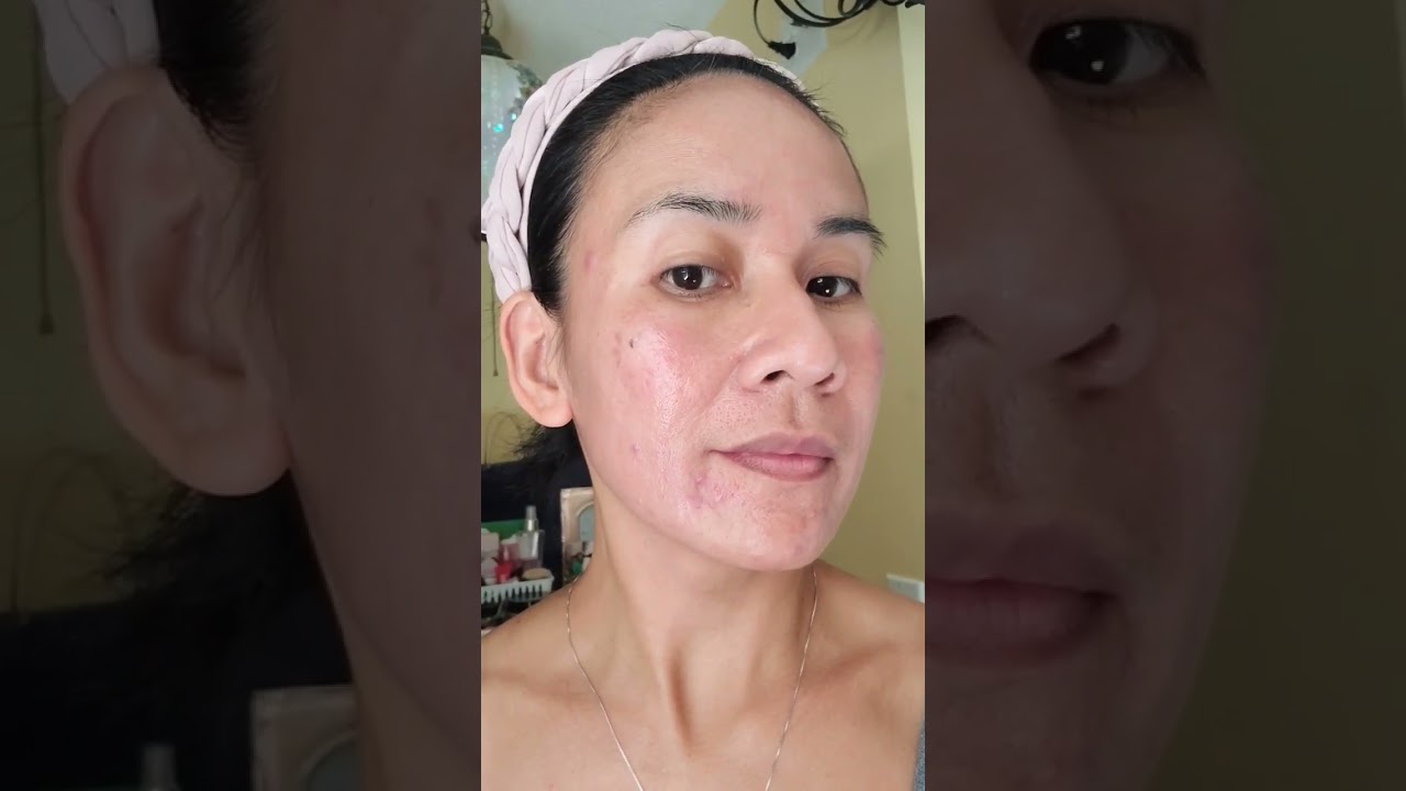 Microdermabrasion | 1 week after treatment | rejuvenation |acne | acne ...