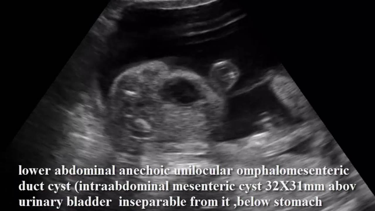 Omphalomesenteric Duct