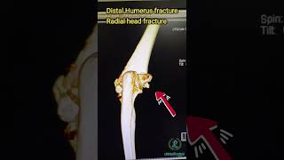Distal Humerus fracture| Radial Head fracture| Humerus ... | Doovi