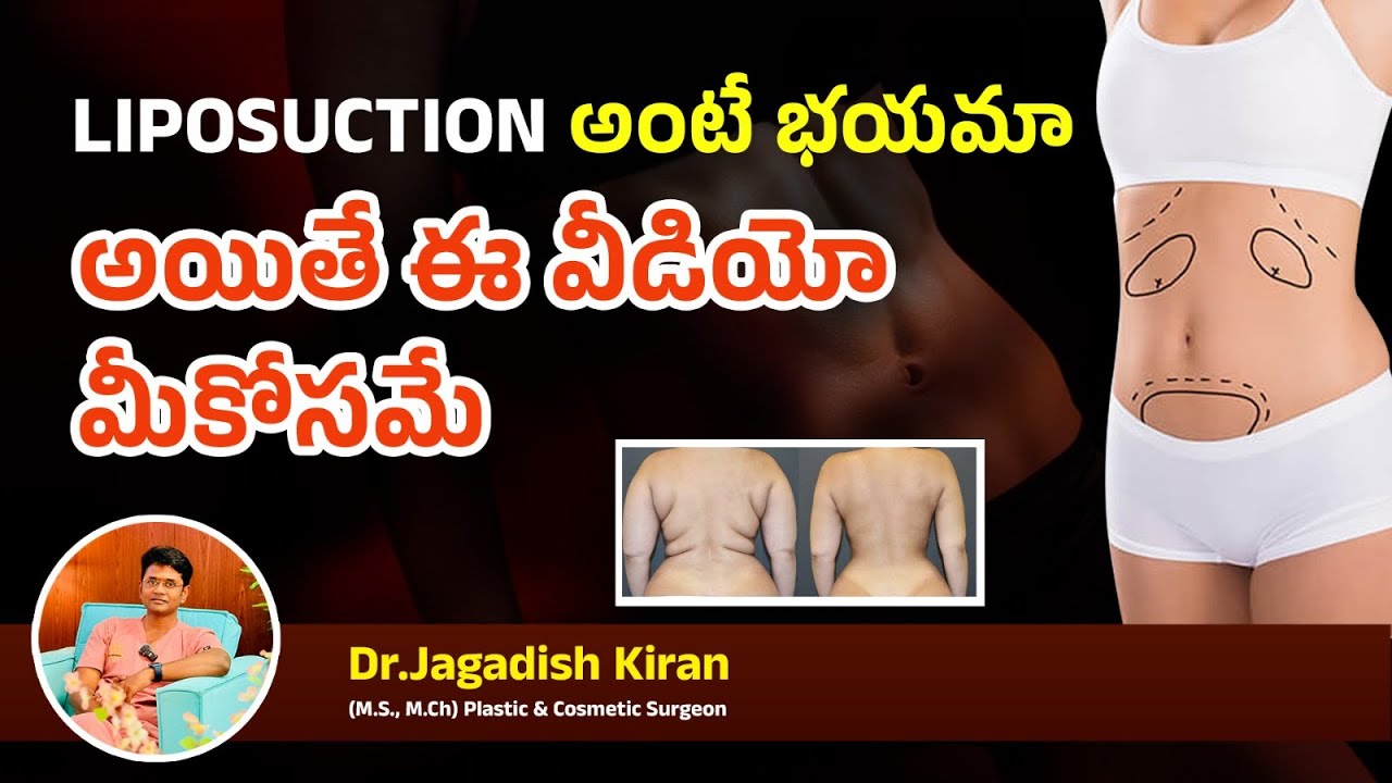 Dealing with Liposuction Complications: What to Watch Out For | Liposuction Surgery in Hyderabad ...