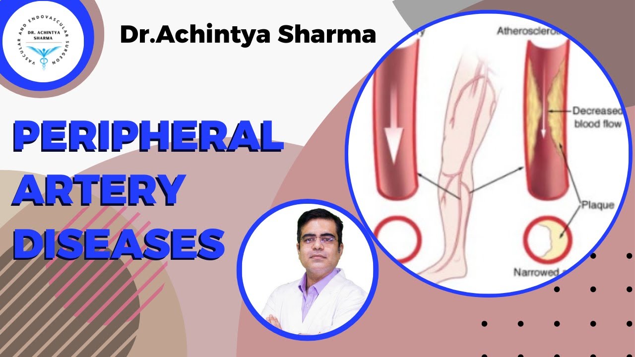 Peripheral Artery Diseases: Symptoms, Treatment & Cure | DR. Achintya ...