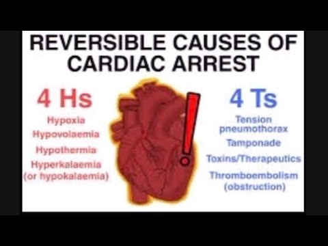 Reversible Causes of Cardiac Arrest: 4T’s - YouTube