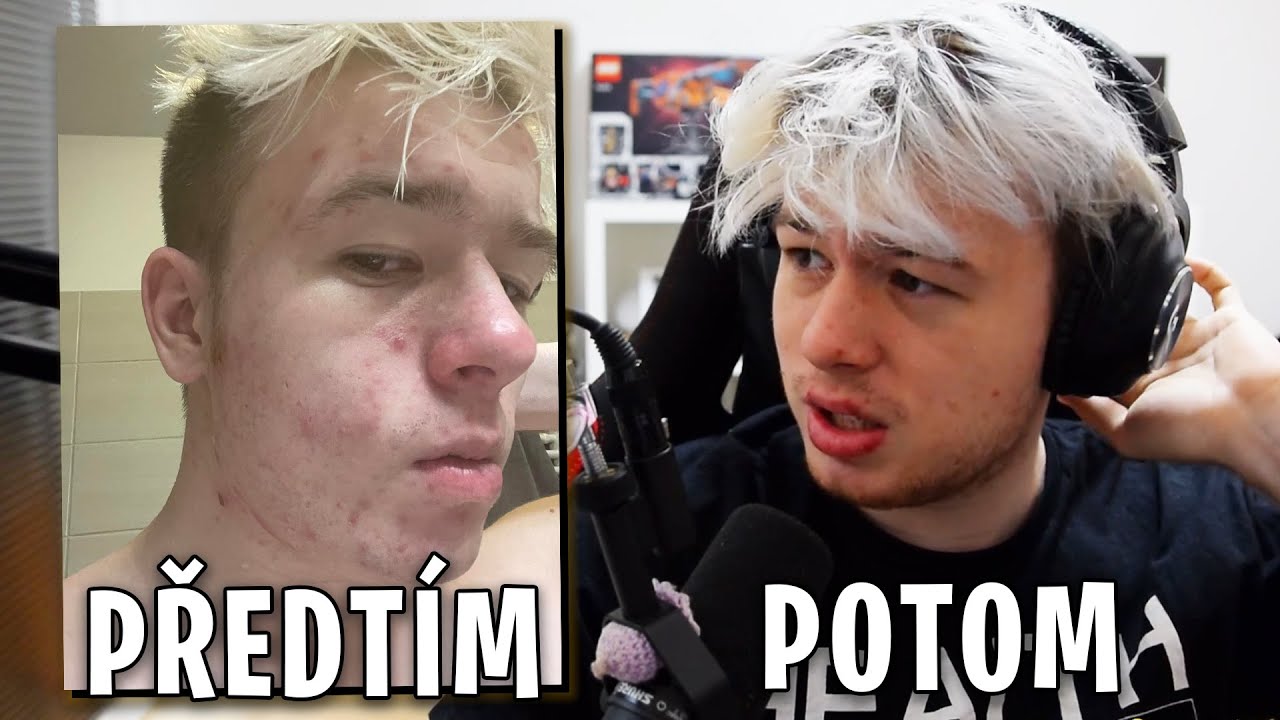 AKNÉ - Moje zkušenost - YouTube