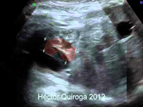 Ectopia Renal - YouTube