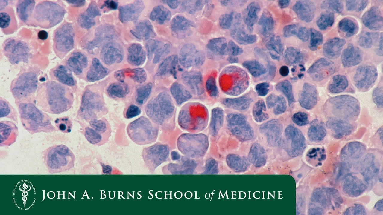 Leukemia - Types and Updates in Treatment by Craig Boddy, MD (Spring ...