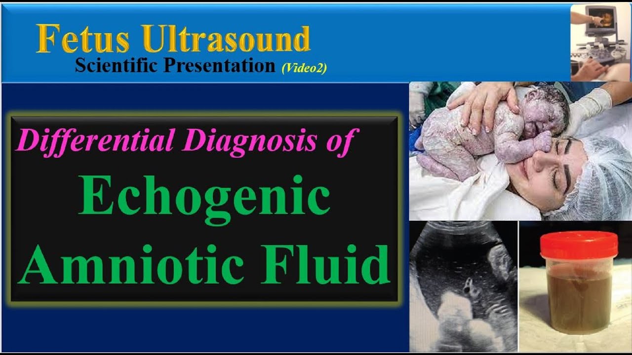 Fetus Ultrasound , Echogenic Amniotic Fluid - YouTube