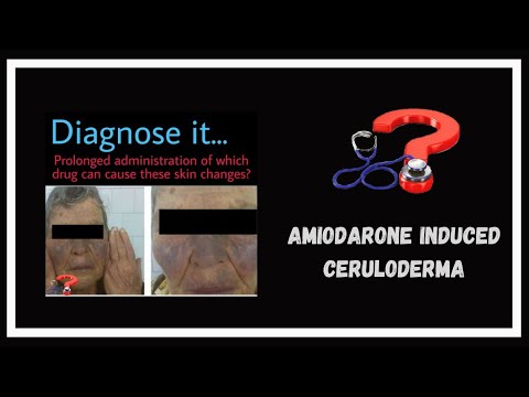 Drug induced hyperpigmentation - amiodarone - YouTube