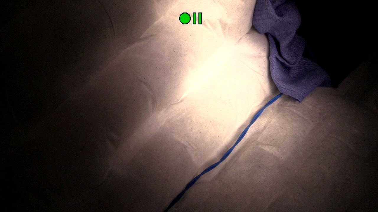 Removal of an axillary soft tissue sarcoma - YouTube