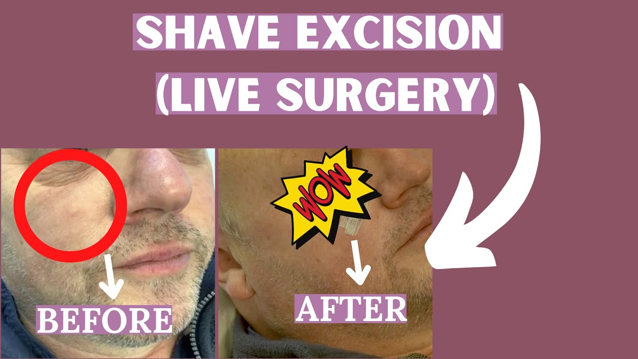 Shave excision of a mole on the face - [LIVE SURGERY] - YouTube