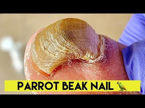 TRIMMING OF ENORMOUS RAMS HORN NAIL 🐏 - YouTube