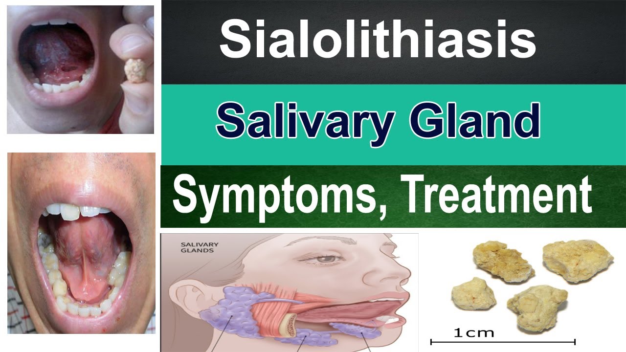 Sialolithiasis lecture - Salivary Gland - Nursing lecture - YouTube