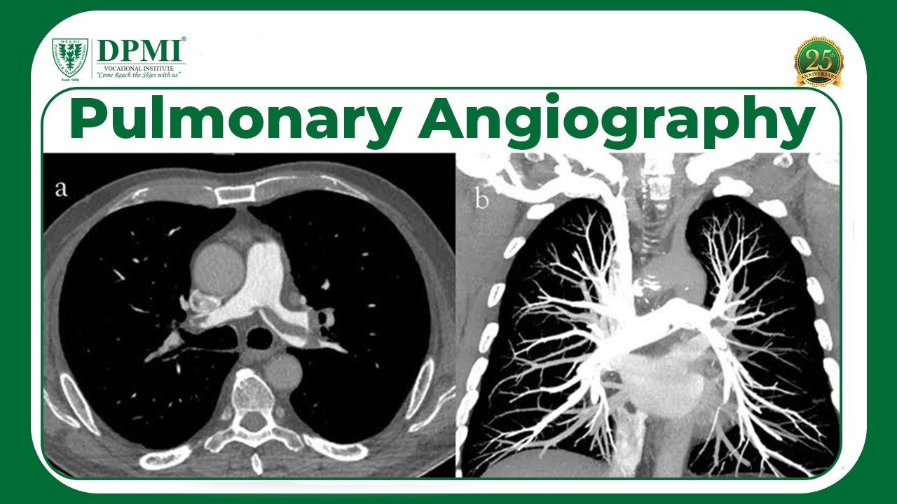 Pulmonary Angiography: Indications, Techniques & Results? What Is ...