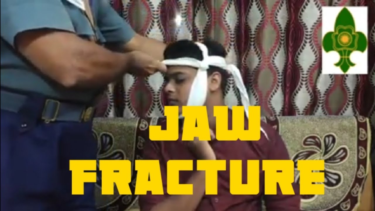 JAW FRACTURE/part-35/First Aid/Scouts&Guides/Scout Masters Corner ...