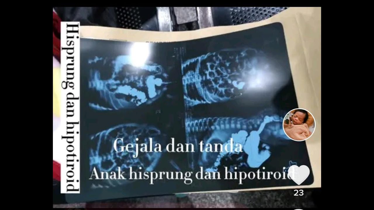 Gejala & tanda bayi terkena Hisprung dan hipoteroid kongenital # ...