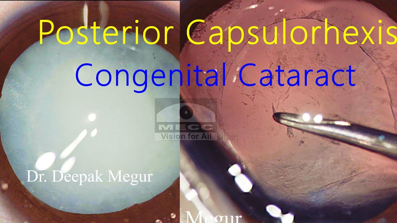 Posterior Capsulorhexis in a case of Congenital Cataract with Nystagmus ...