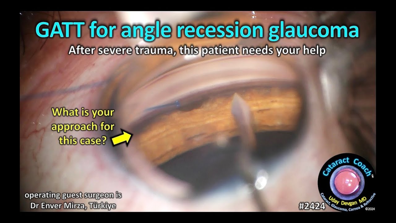CataractCoach™ 2424: GATT for traumatic angle recession glaucoma - YouTube