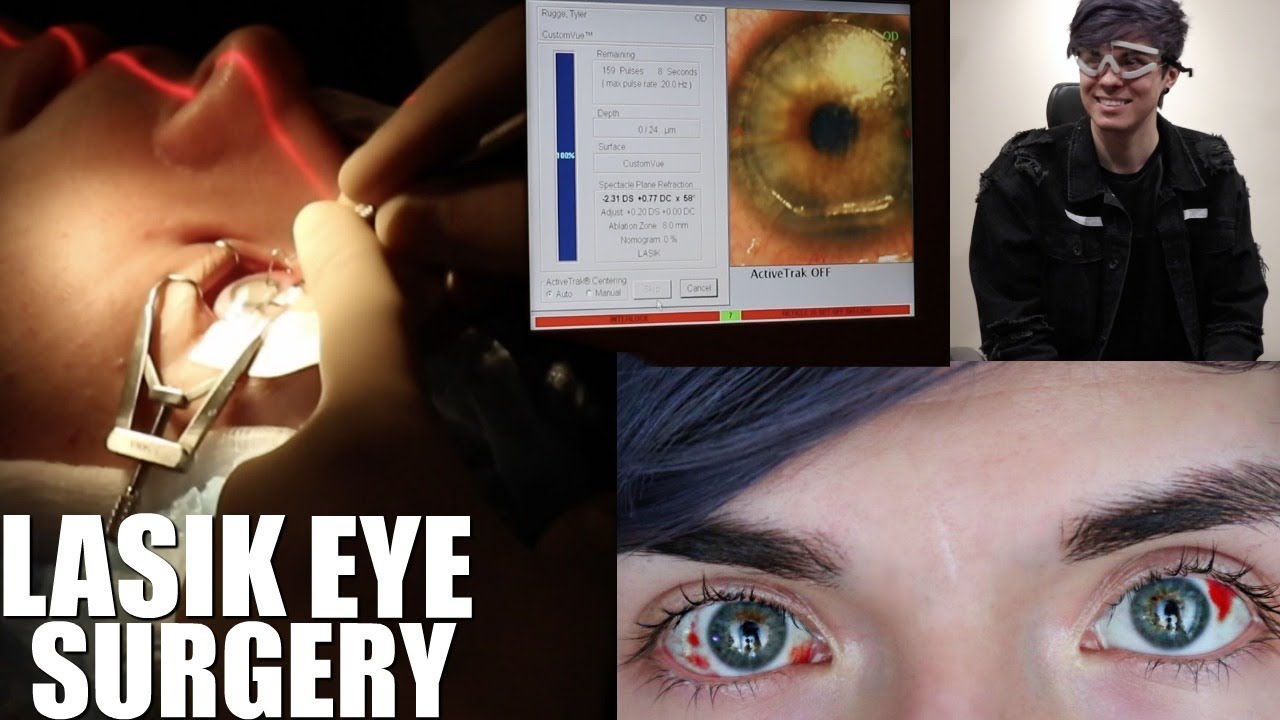 My Lasik Eye Surgery Experience! *LIVE FOOTAGE* | LasikPlus - YouTube