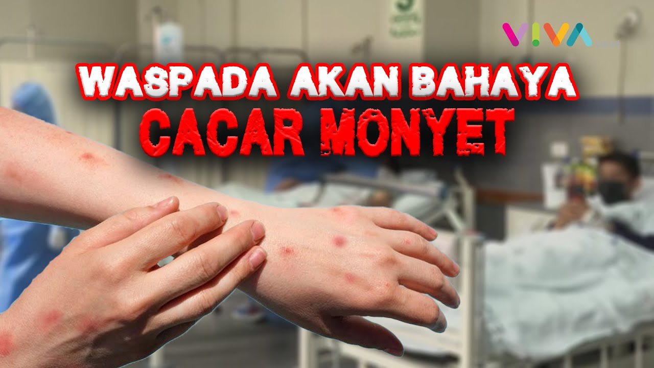 Cacar Monyet Masuk Indonesia, Ini Gejala dan Cara Pencegahannya - YouTube
