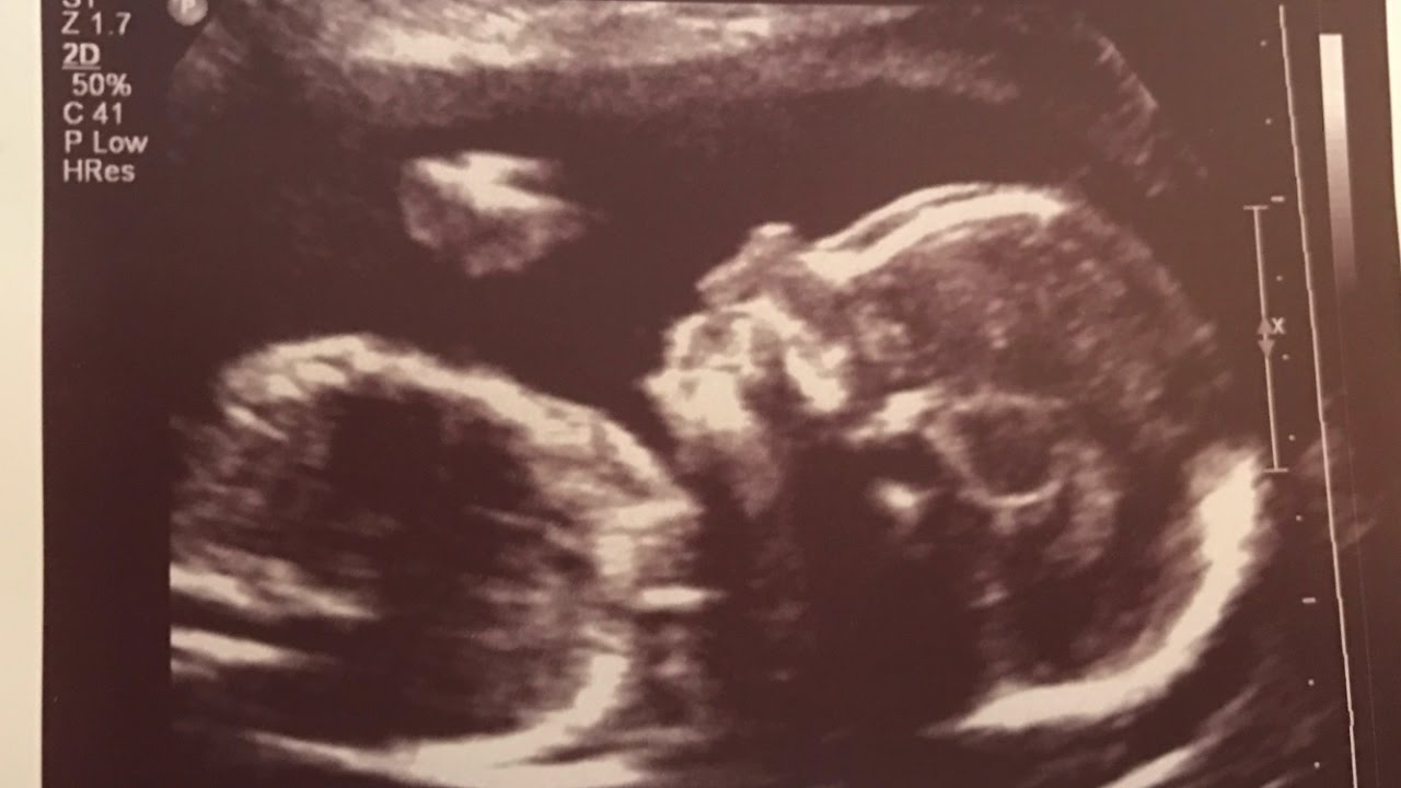 20 Week Anatomy Scan Its A BOY YouTube 20 Week Anatomy Scan Its A BOY YouTube