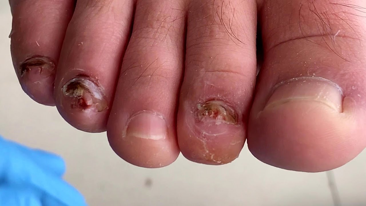 Pedicure tutorial: treatment of onychomycosis, detailed process【Xue ...