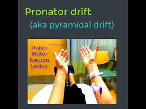 Pronator drift - YouTube