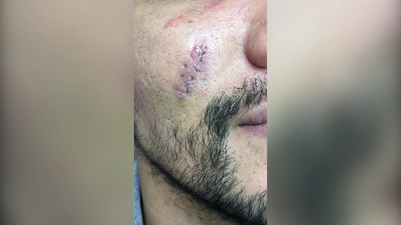 PART 3 - DEPRESSED RIGHT CHEEK SCAR - DR. TANVEER JANJUA - NEW JERSEY ...