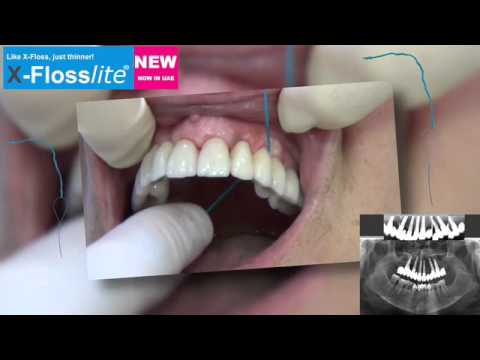 Cleaning your implants with X-Floss / Upper Jaw - YouTube