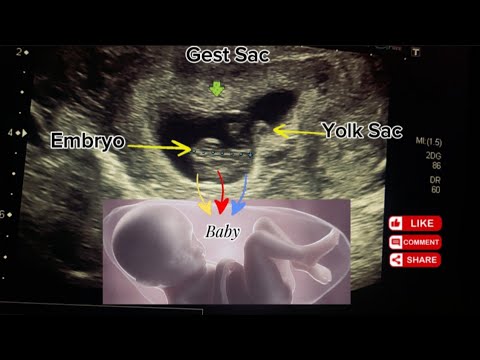 What Can You See At 8 Weeks Baby/Pregnancy Scan | Gestational Sac, Yolk ...