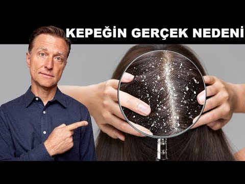 KEPEĞİN GERÇEK NEDENİ VE TEDAVİSİ | Dr.Berg Türkçe