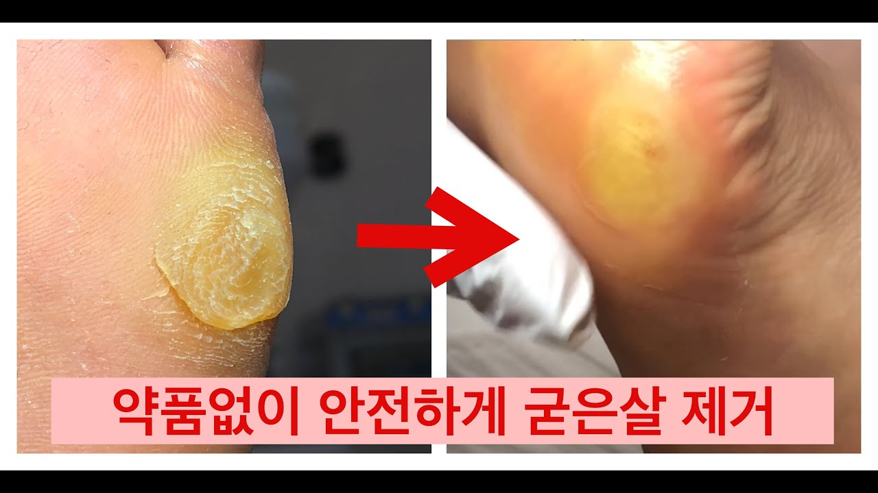 굳은살 제거 - 레푸스 원주점 Removing dead skin cells of the foot. - YouTube