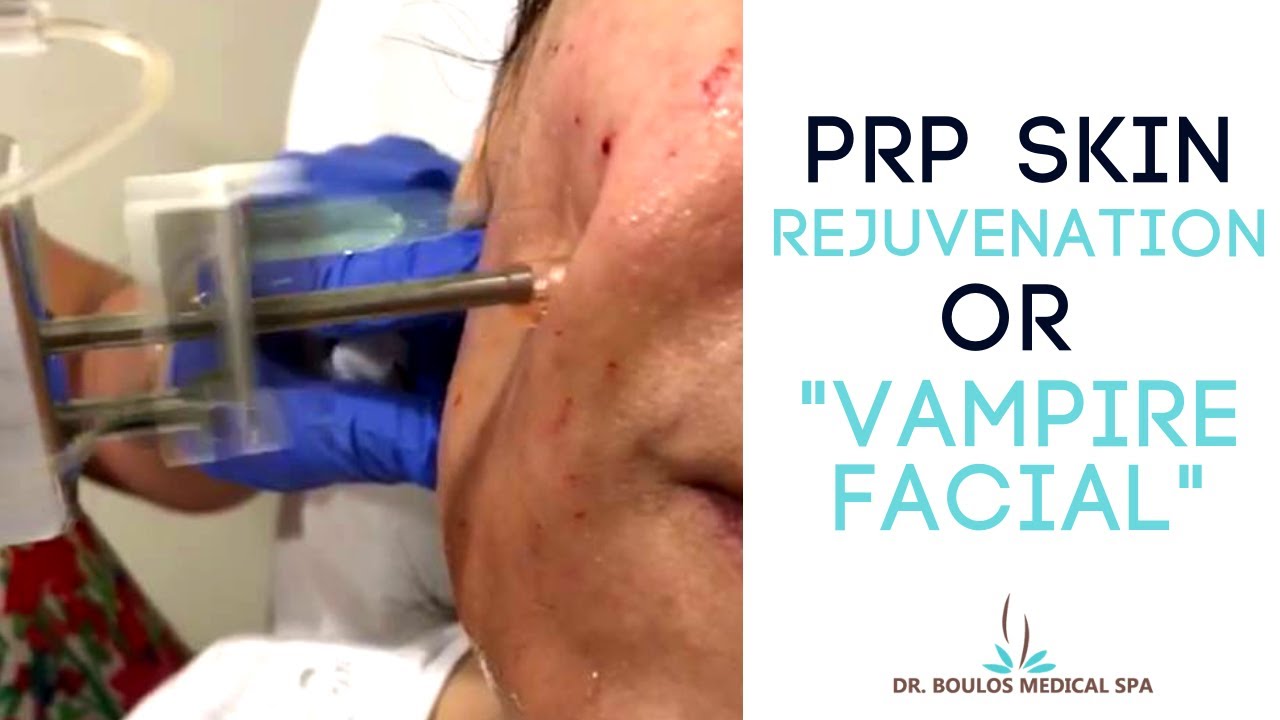 PRP Skin Rejuvenation is also known as Vampire Facial or Vampire Lift ...
