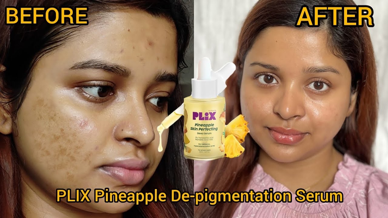 How I cleared my pigmentation by using Plix De-pigmentation Serum - YouTube
