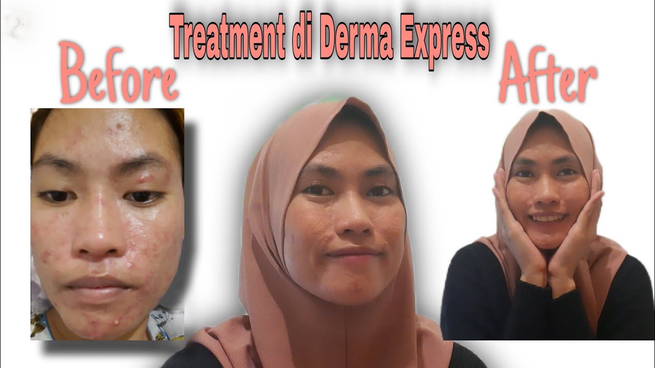 BEFORE - AFTER TREATMENT DI DERMA EXPRESS || MY ACNE STORY # ...