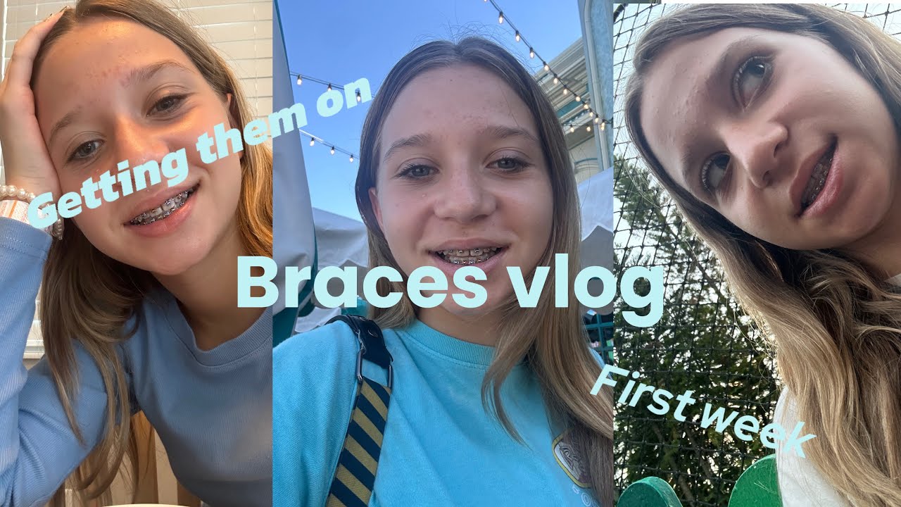 Getting my braces on vlog! (And the first week!) #braces #dentist #vlog ...
